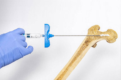 Flowbone Raises CHF 2.1 Million to Bring Nanomedicine-based Bone Repair ...